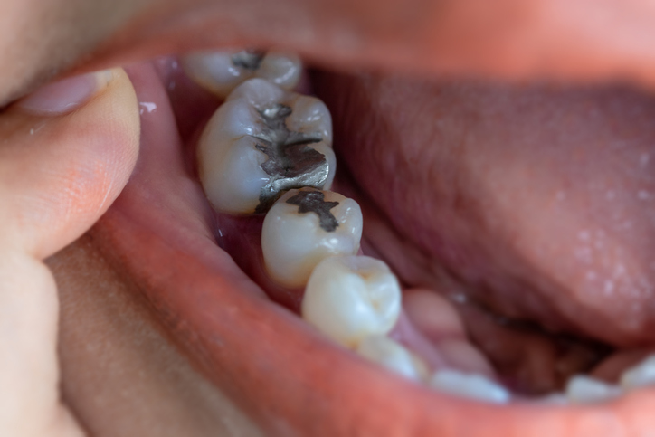 Are the Black Fillings in Your Teeth a Turn Off?